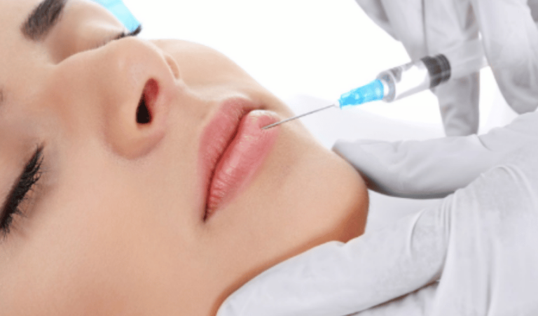 Techniques For Dermal Filler Injection For Fuller Lips – Aesthetic Arts ...